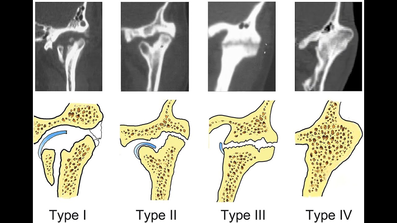 Lateral Pole Excision of Ankylosis of TMJ rt Side - YouTube