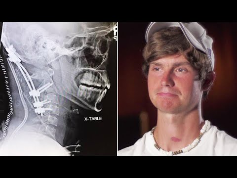 Indiana Man Is Rare Survivor of 'Internal Decapitation'