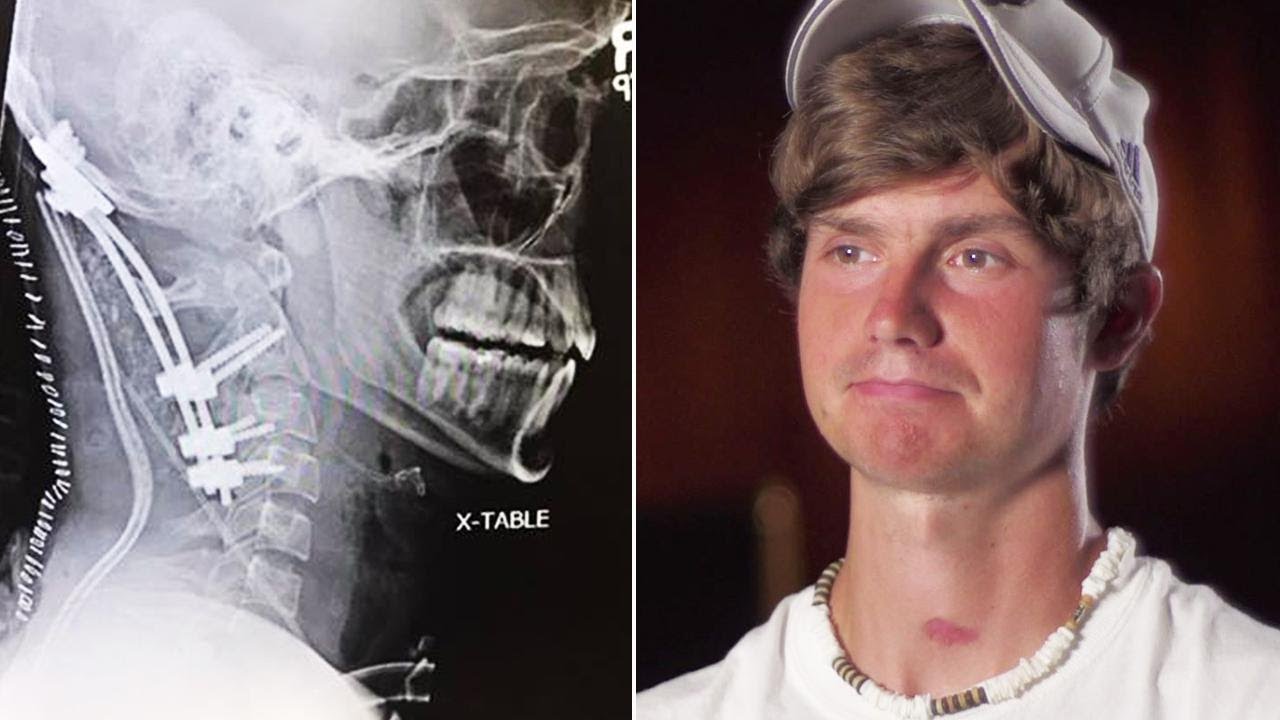 Indiana Man Is Rare Survivor of 'Internal Decapitation' - YouTube