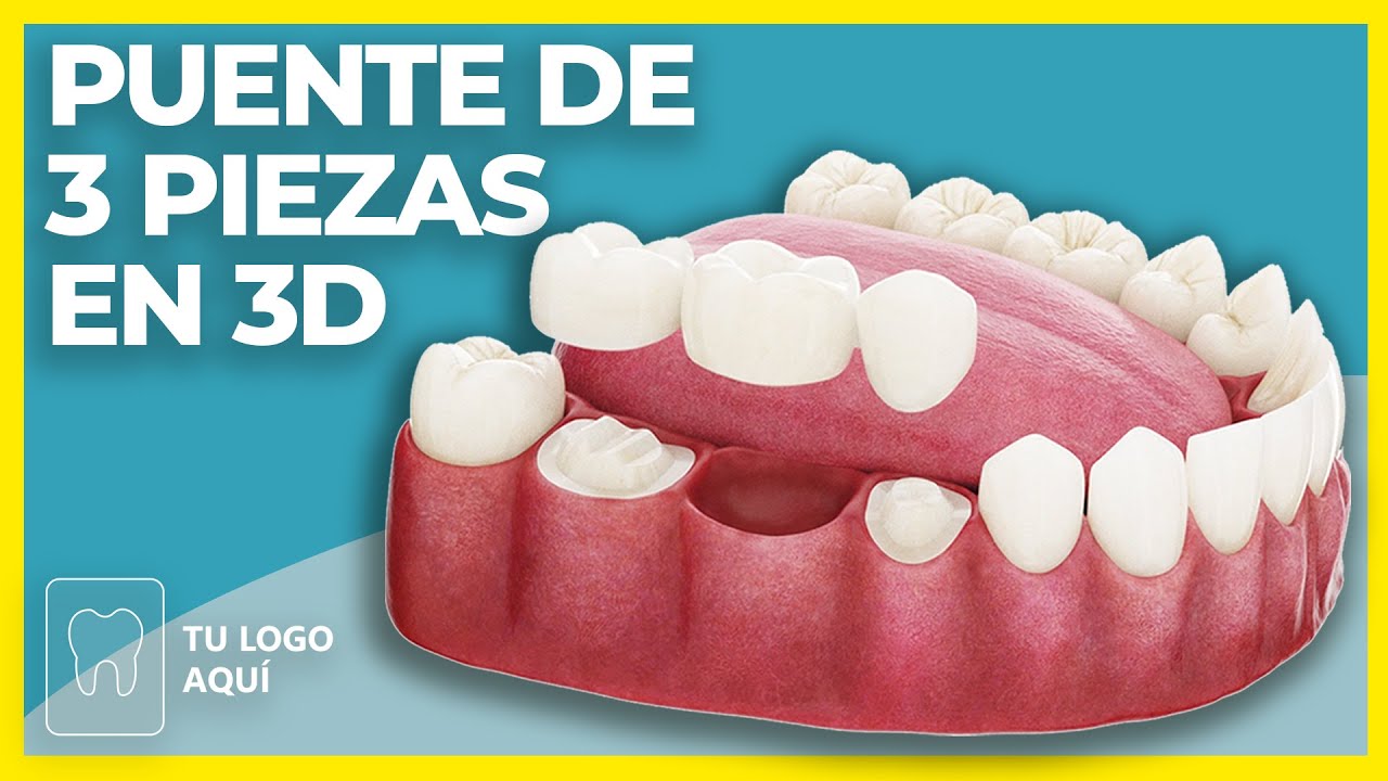 PUENTE DE 3 PIEZAS 🦷 Vídeos dentales 3D - Pedagogía de pacientes de ...