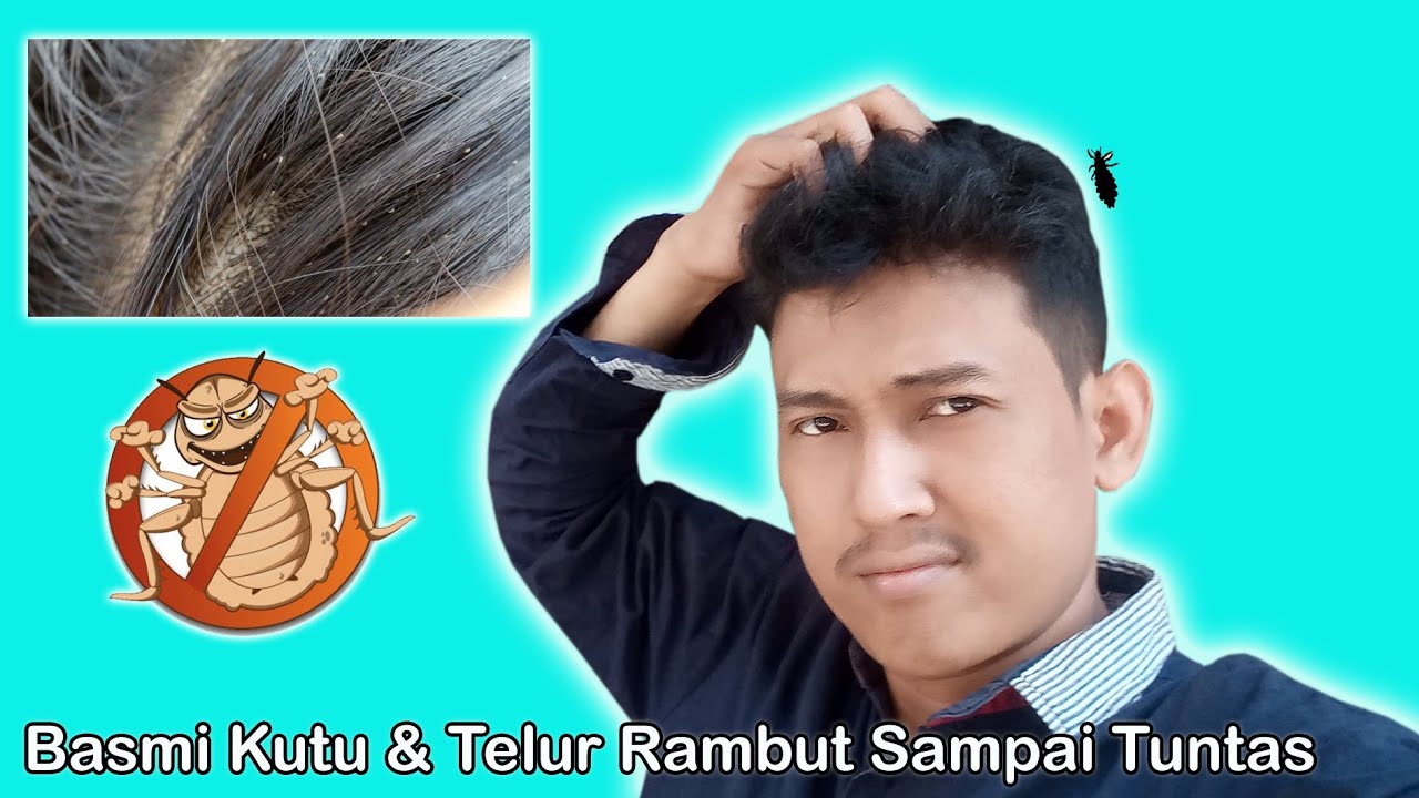 Cara mudah menghilangkan kutu rambut & telur nyah, sampai habis tuntas ...
