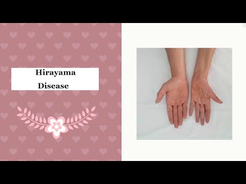 Hirayama disease and my history.