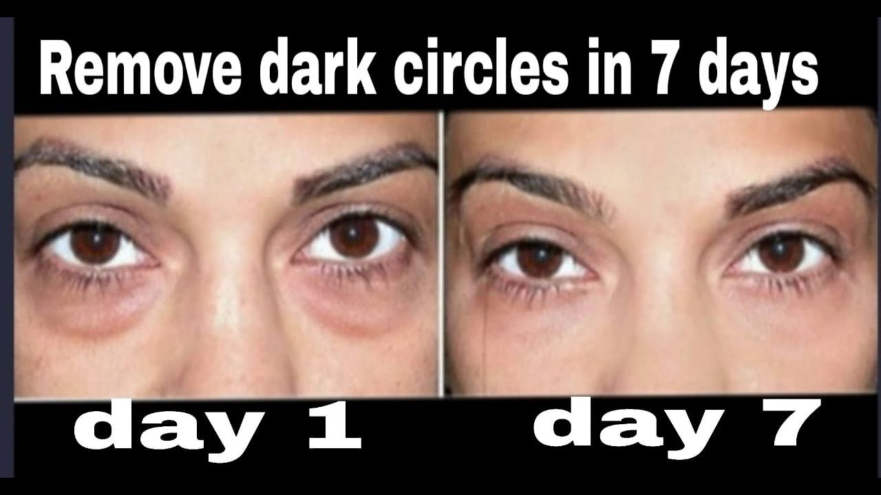 How to Get Rid of Dark Circles in 7 days | Tips and Natural Remedies ...