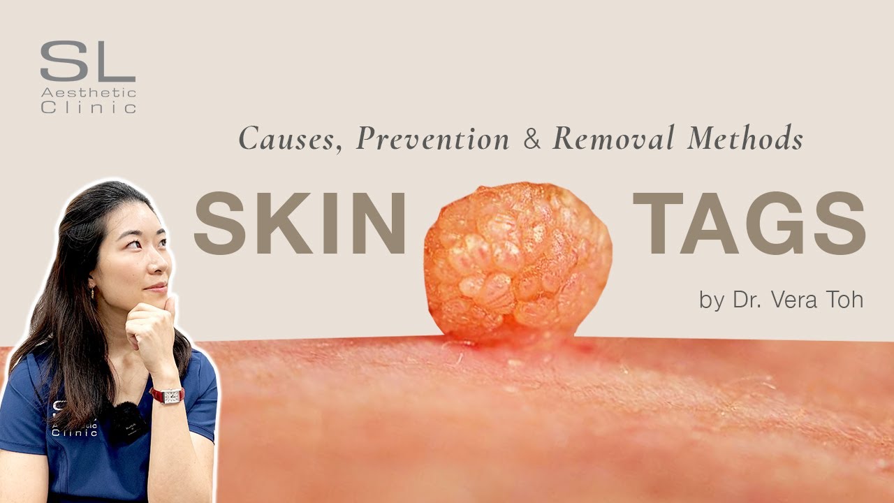 All about SKIN TAGS 👀 - Causes, Prevention & Removal #aesthetic #doctor ...