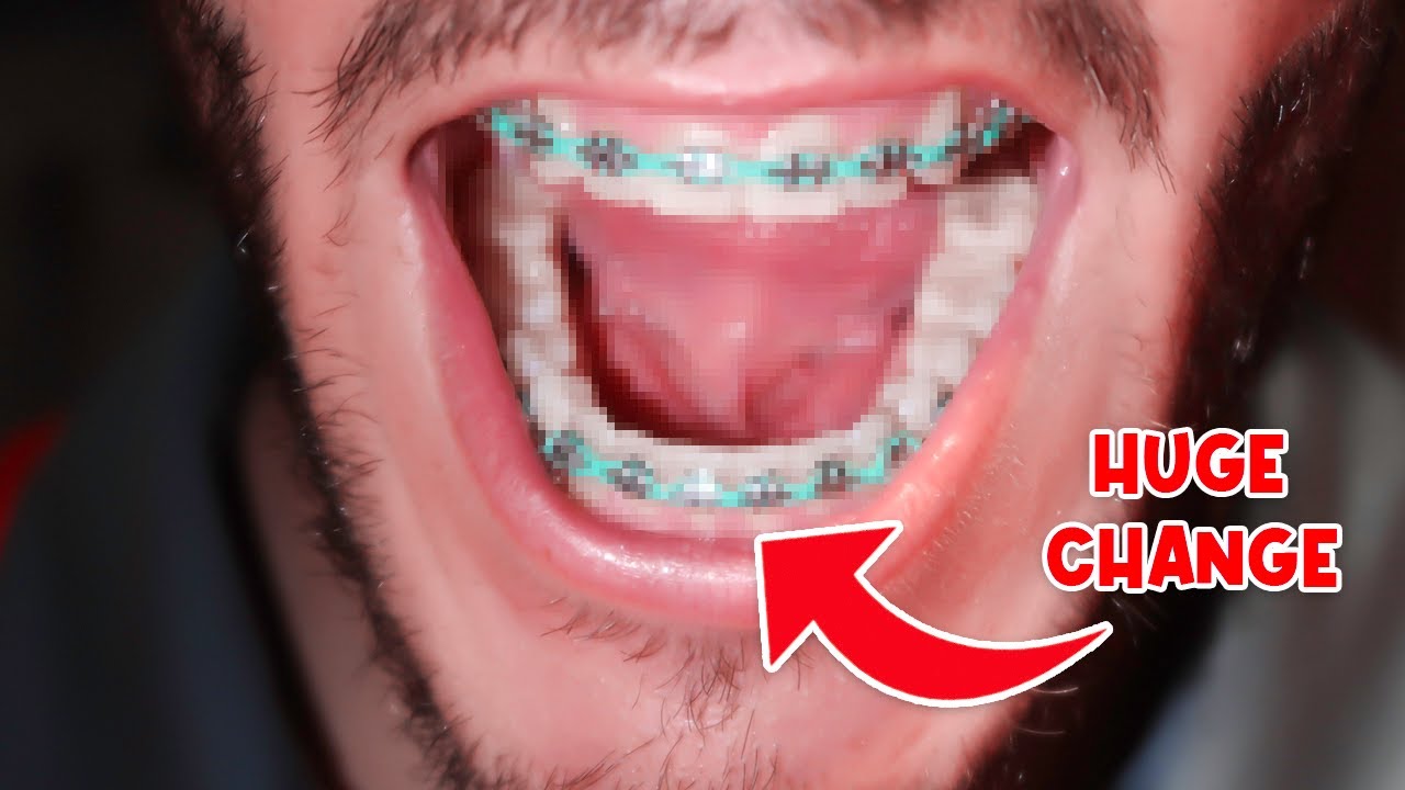 23 YEAR OLD WITH BRACES HAS DRAMATIC CHANGE! - YouTube