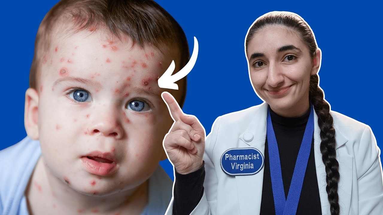 How to treat chickenpox on eyebrow near eye - YouTube