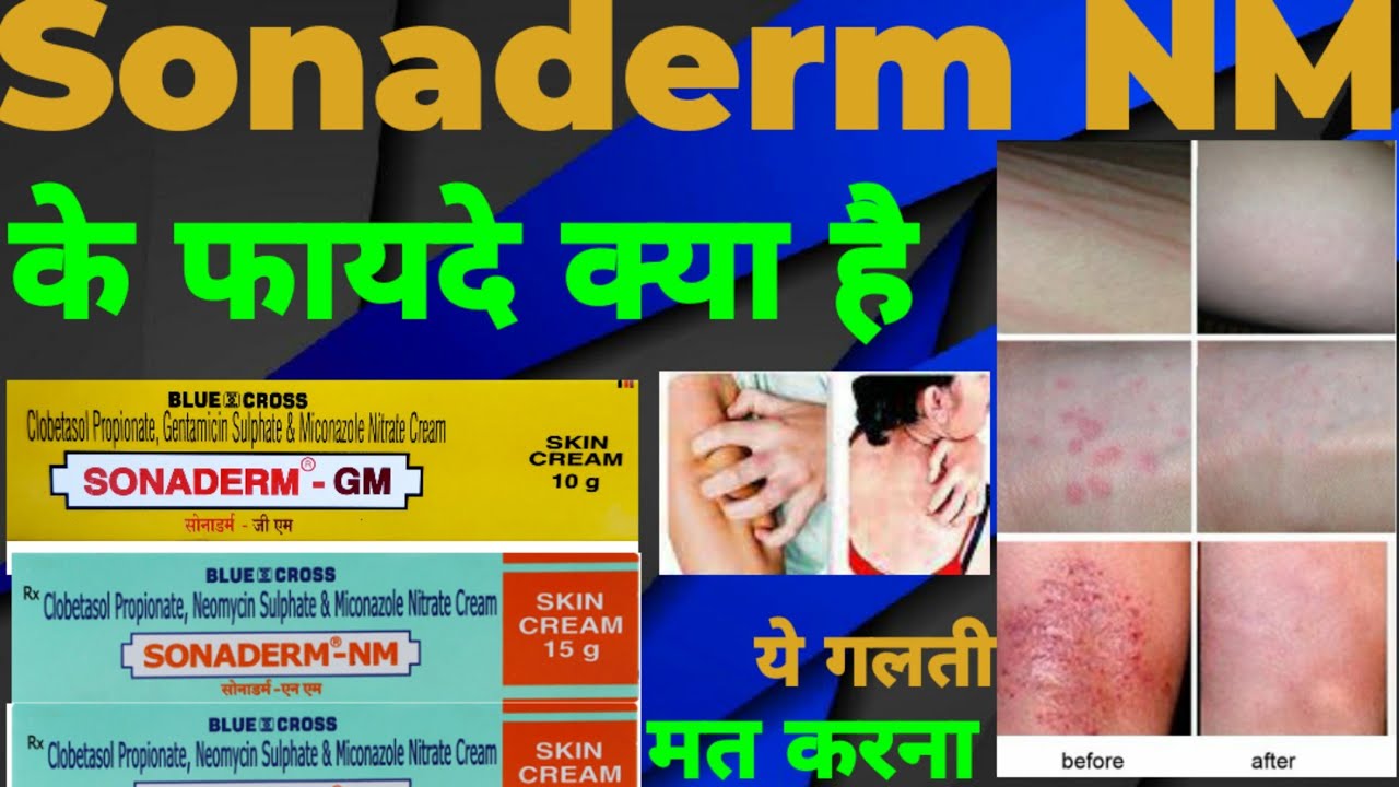 Sonaderm NM Uses in Hindi | Sonaderm NM Cream - Uses, Dosage, Side ...