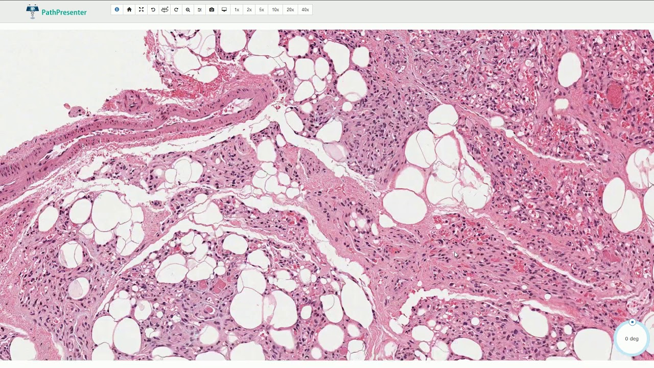Angiolipoma - Histopathology - YouTube