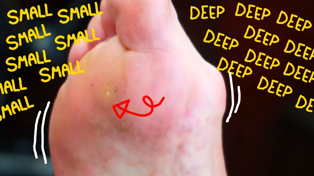 Small but DEEP Corn Removal! Size Doesn't Matter! - YouTube