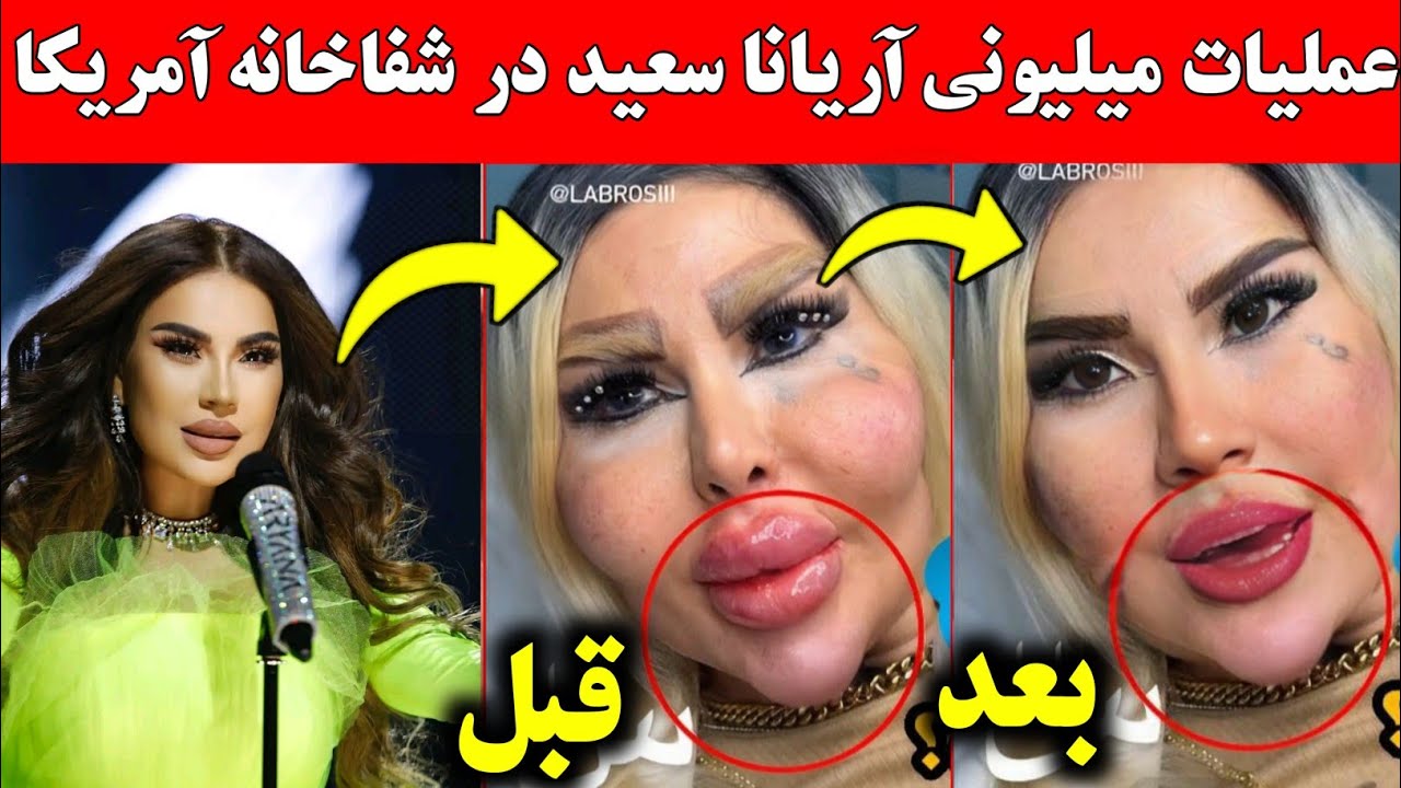 چهره جدیدی آریانا سعید بعد از جراحی زیبایی در شفاخانه آمریکا چهره