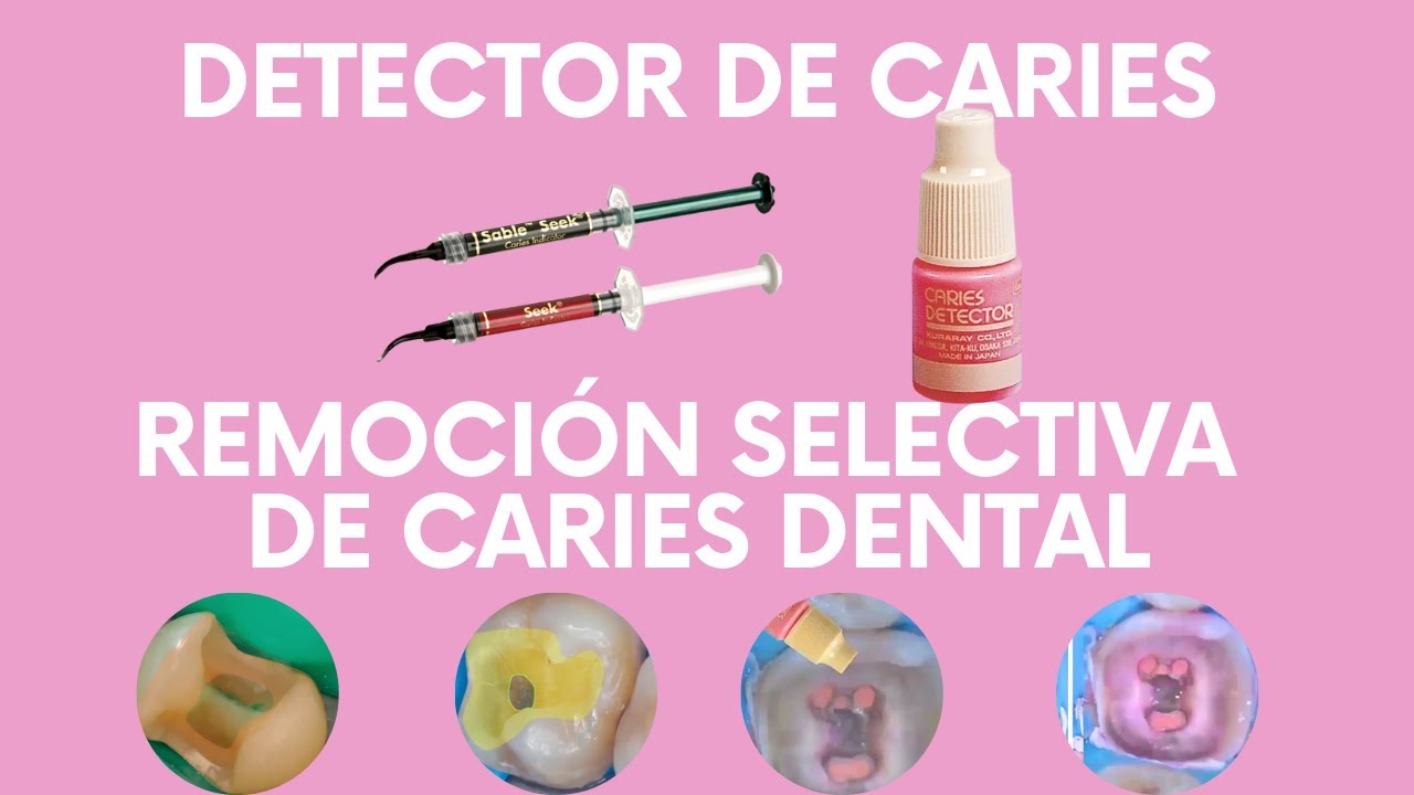 Detector de Caries y Remoción de Caries Selectiva - YouTube