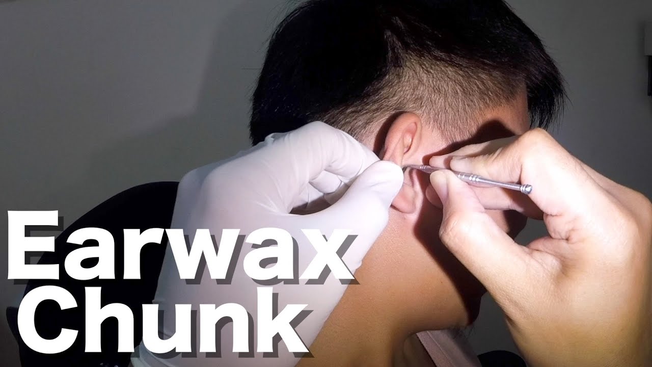 Removing Man's Earwax Chunk Using An Ear Curette - YouTube