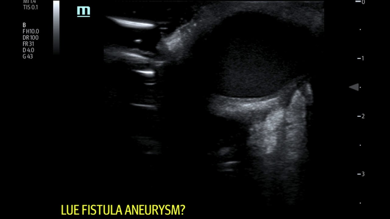 LUE AV Graft Pseudoaneurysm US - YouTube