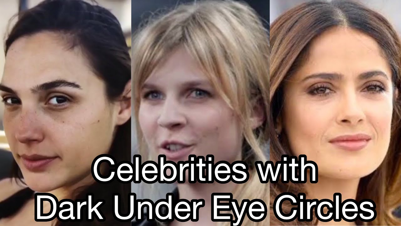 Celebrities With Dark Under Eye Circles - YouTube