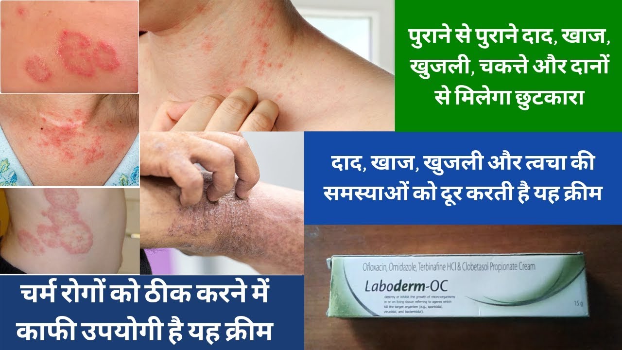 Laboderm-OC Cream to Treat Mixed Dermatitis Conditions | Laboderm-OC ...