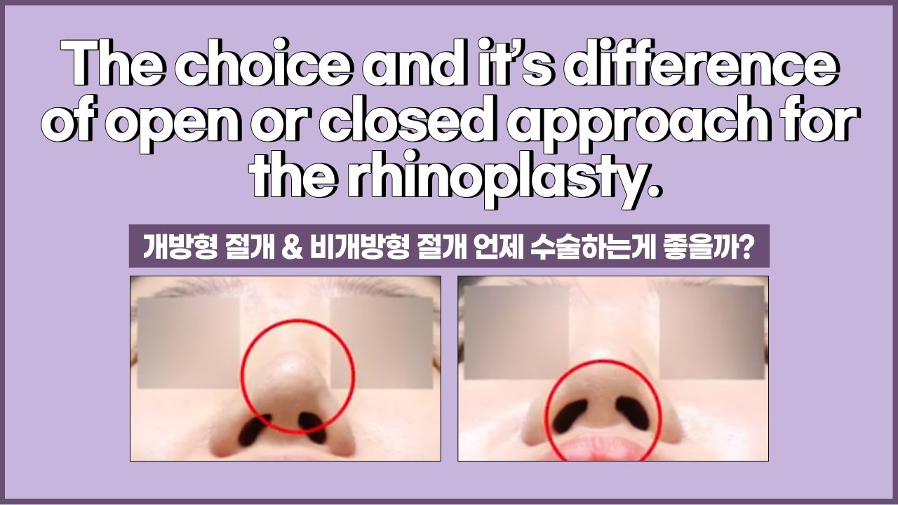 The choice and it’s difference of open or closed approach for the ...