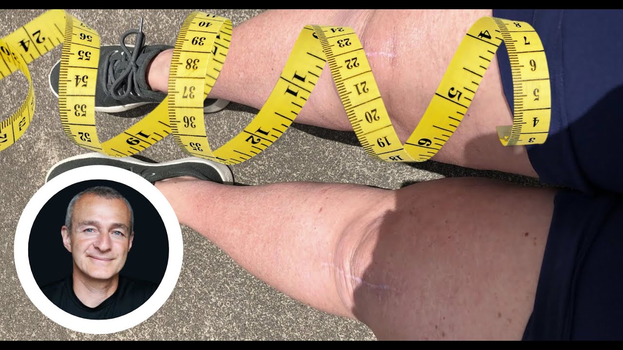 Longer Leg After Knee Replacement YouTube longer-leg-after-knee-replacement-youtube