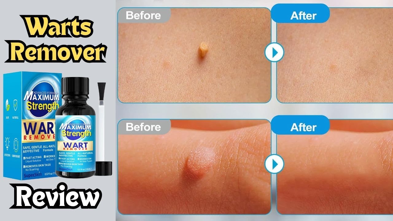 MAXIMUM Strength Wart Removal Gel Changed My Life! | Fast-Acting ...