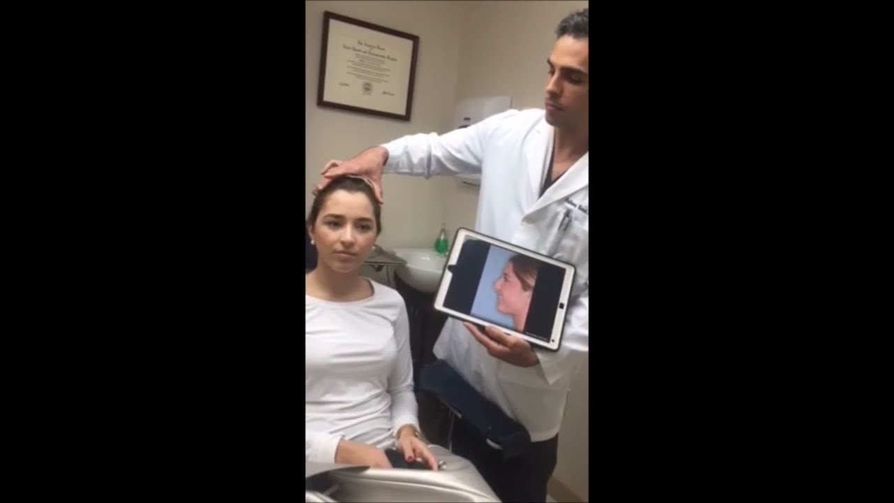Rhinoplasty for hanging columella and flared nostrils - YouTube
