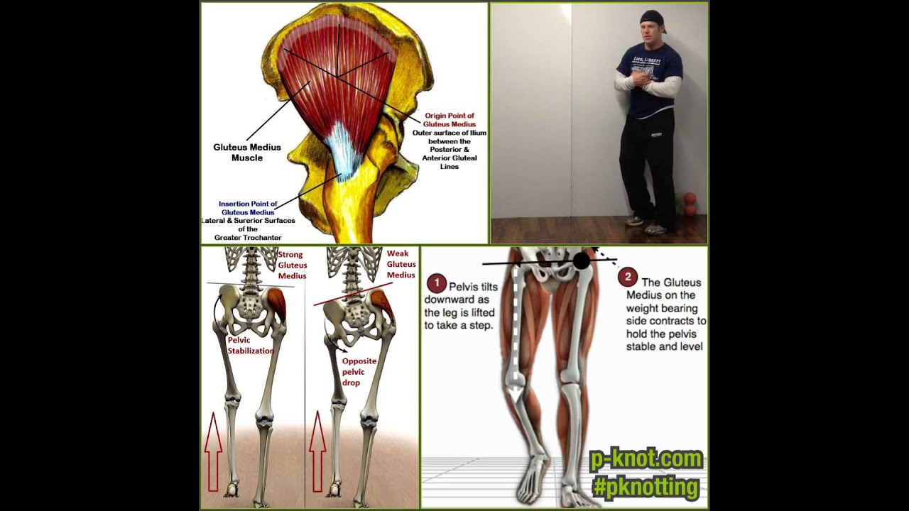 P-Knotting for a positive #Trendelenburg sign: Fixing the walking gate ...