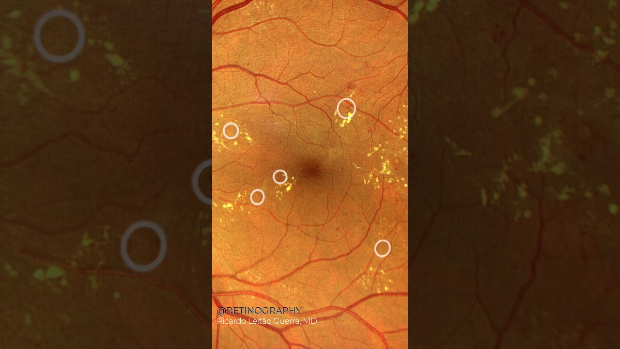 PROLIFERATIVE DIABETIC RETINOPATHY FLUORESCEIN ANGIOGRAPHY ANALYSIS For ...