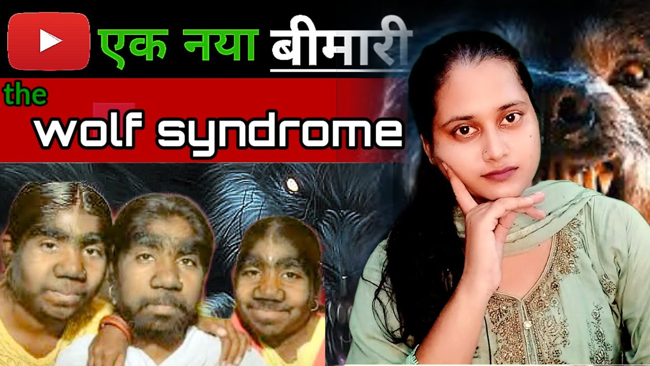 Wolf Syndrome Disease ll Hypertrichosis ll wolf man syndrome - YouTube