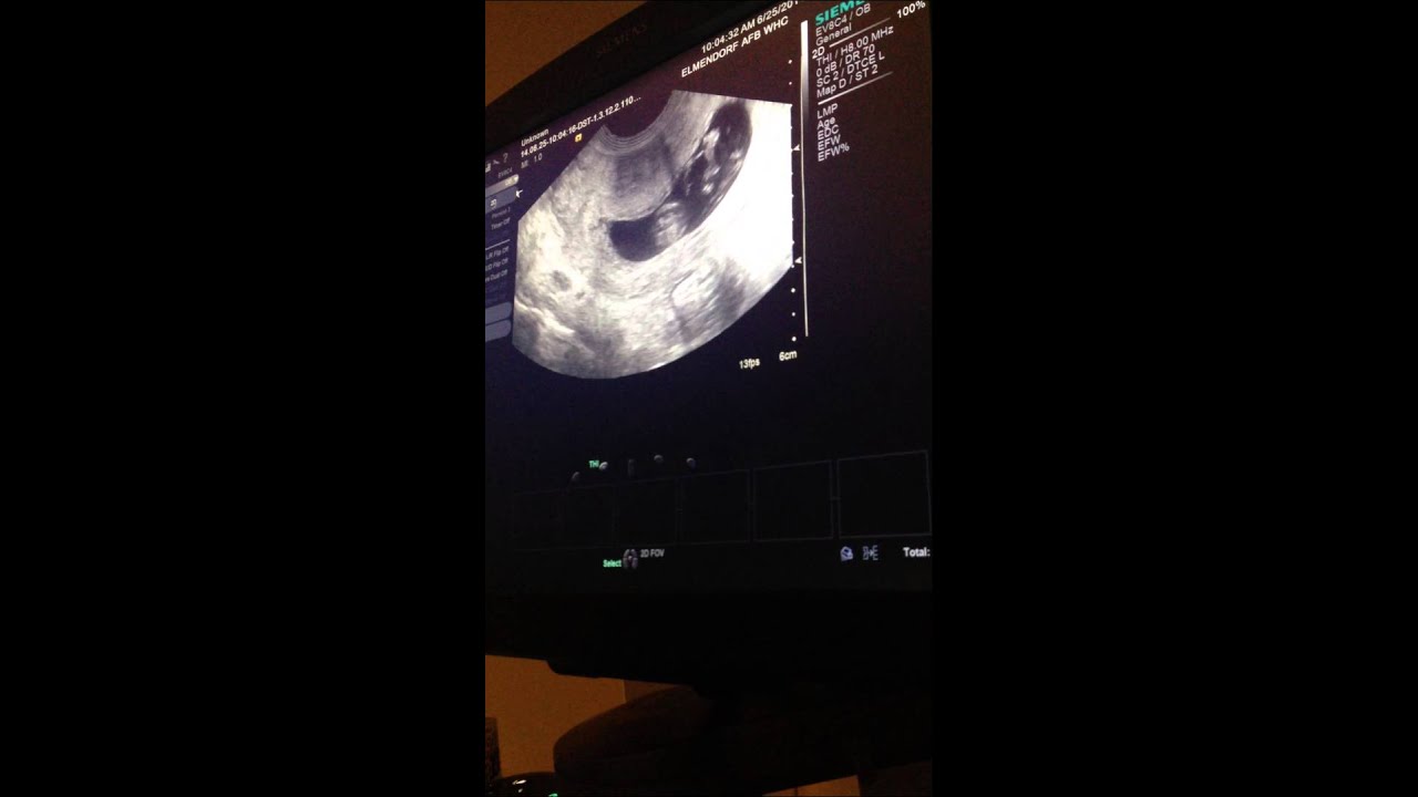 9 weeks 5 days ultrasound - Baby is moving! - YouTube