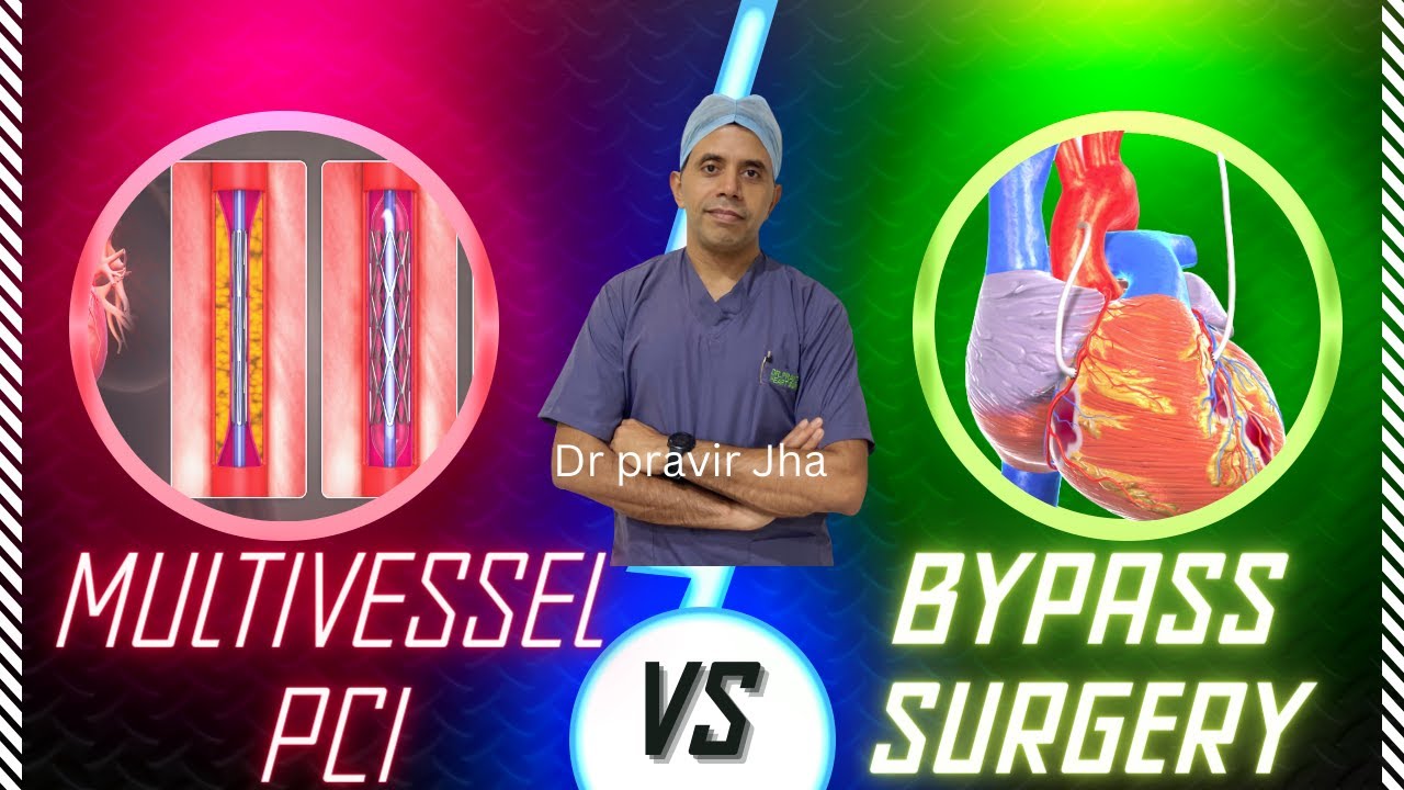 multivessel PCI vs Bypass Surgery | मल्टीप्ल स्टेंटिंग और बाईपास सर्जरी ...
