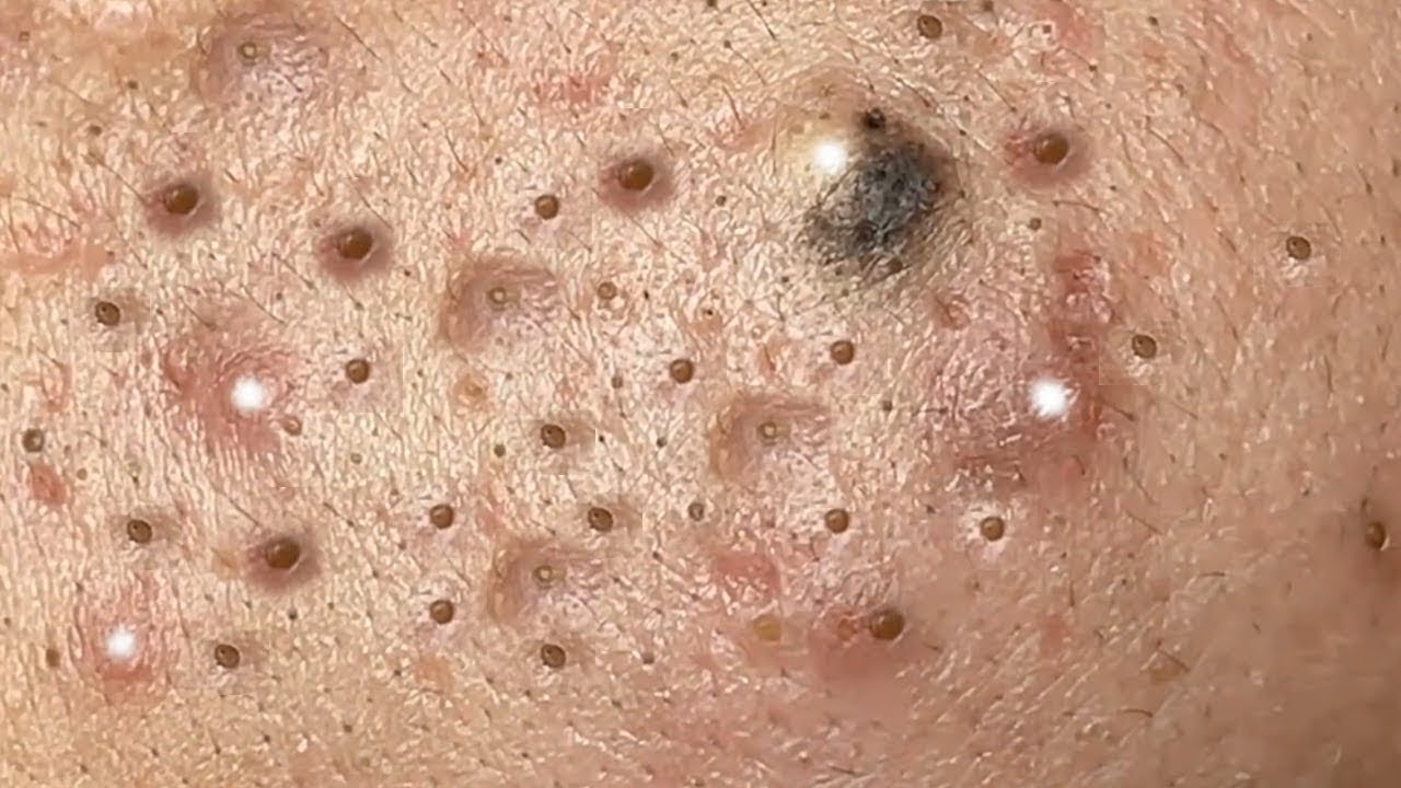 Blackheads And Milia Big Cystic Acne Blackheads Extraction Whiteheads