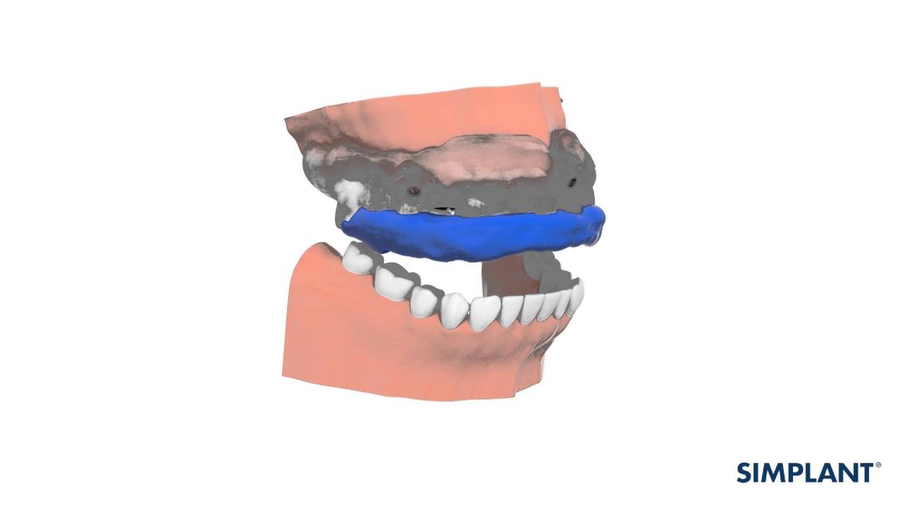 Verwendung der SIMPLANT Schablone (SIMPLANT Guide) - YouTube