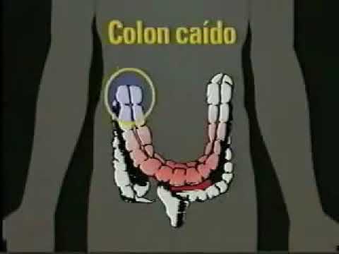 Colón caído (el exceso de toxicidad) - YouTube