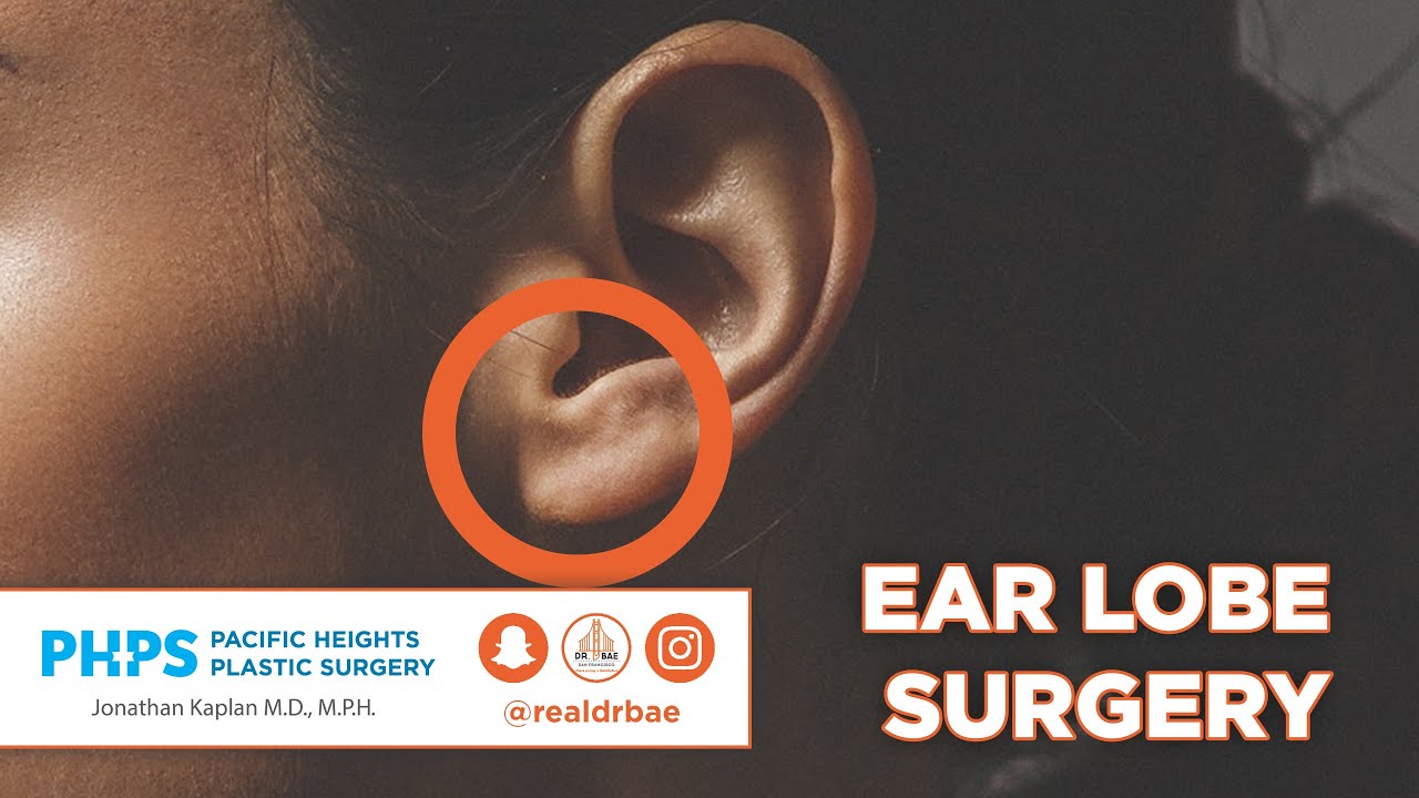 *EAR LOBE SURGERY* - Is It A Thing!? | Pacific Heights Plastic Surgery ...