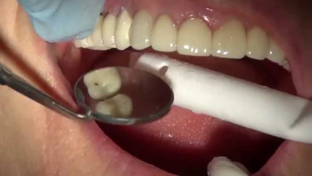pulling tooth ,implant placemant - YouTube