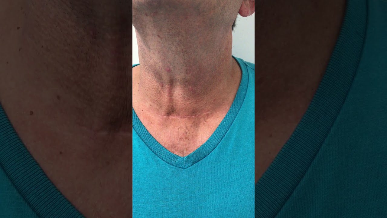 Cicatrice de thyroïdectomie adhérente - YouTube