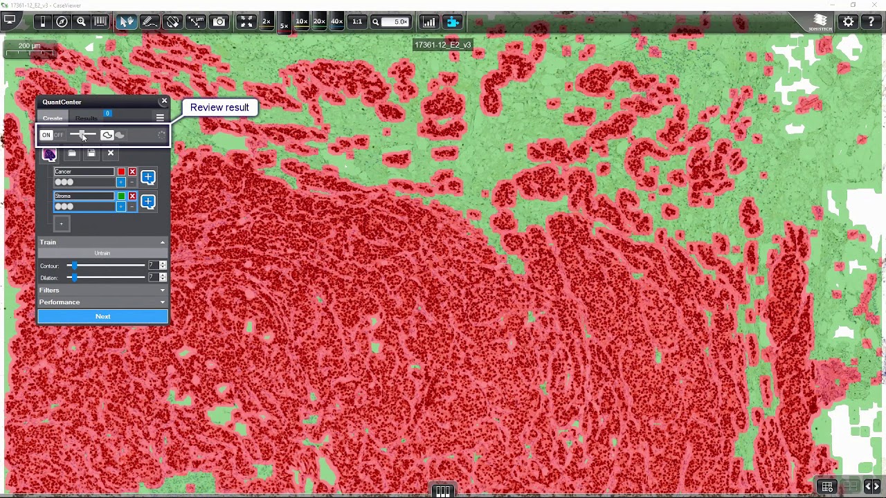 3DHISTECH - Breast Cancer Tissue Analysis using PatternQuant and ...