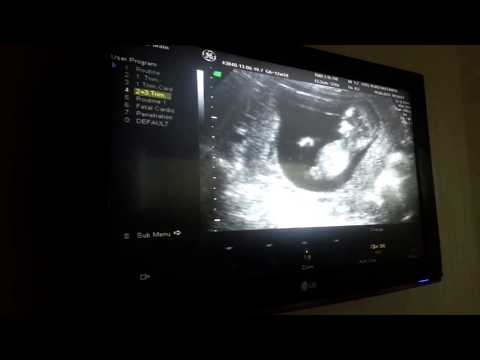 Bebek Benli 12 haftalık ultrason zıplayan bebek, 12 weeks pregnant jumping baby ultrasound