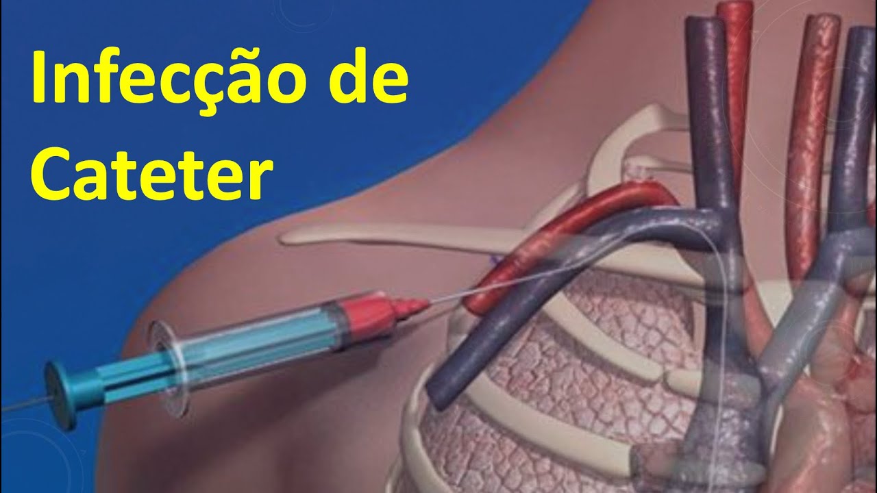Infecção de Cateter - YouTube