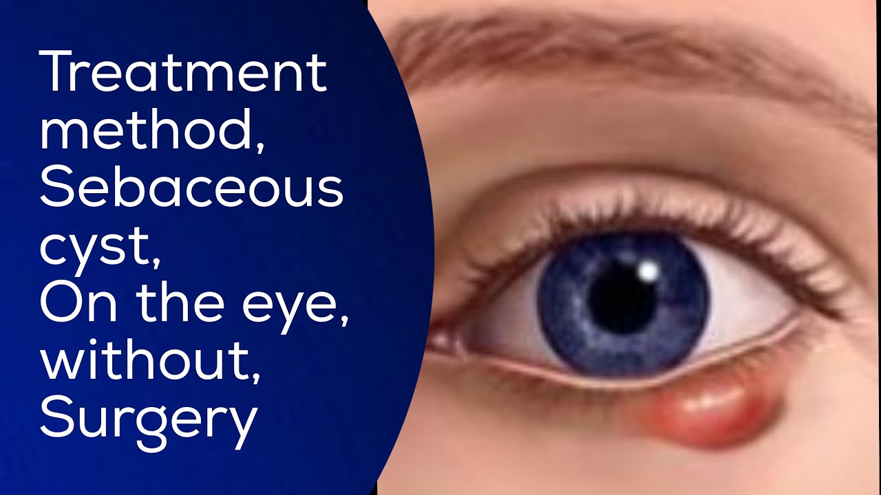The ultimate treatment for a cyst. On the eyes and on the skin - YouTube