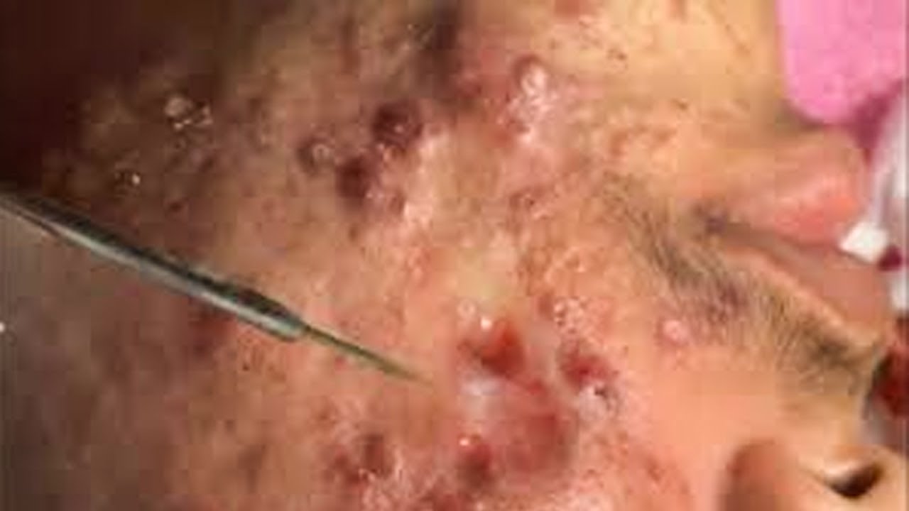 New Pimple Popping Videos | TikTok Compilation | Acne removing - YouTube