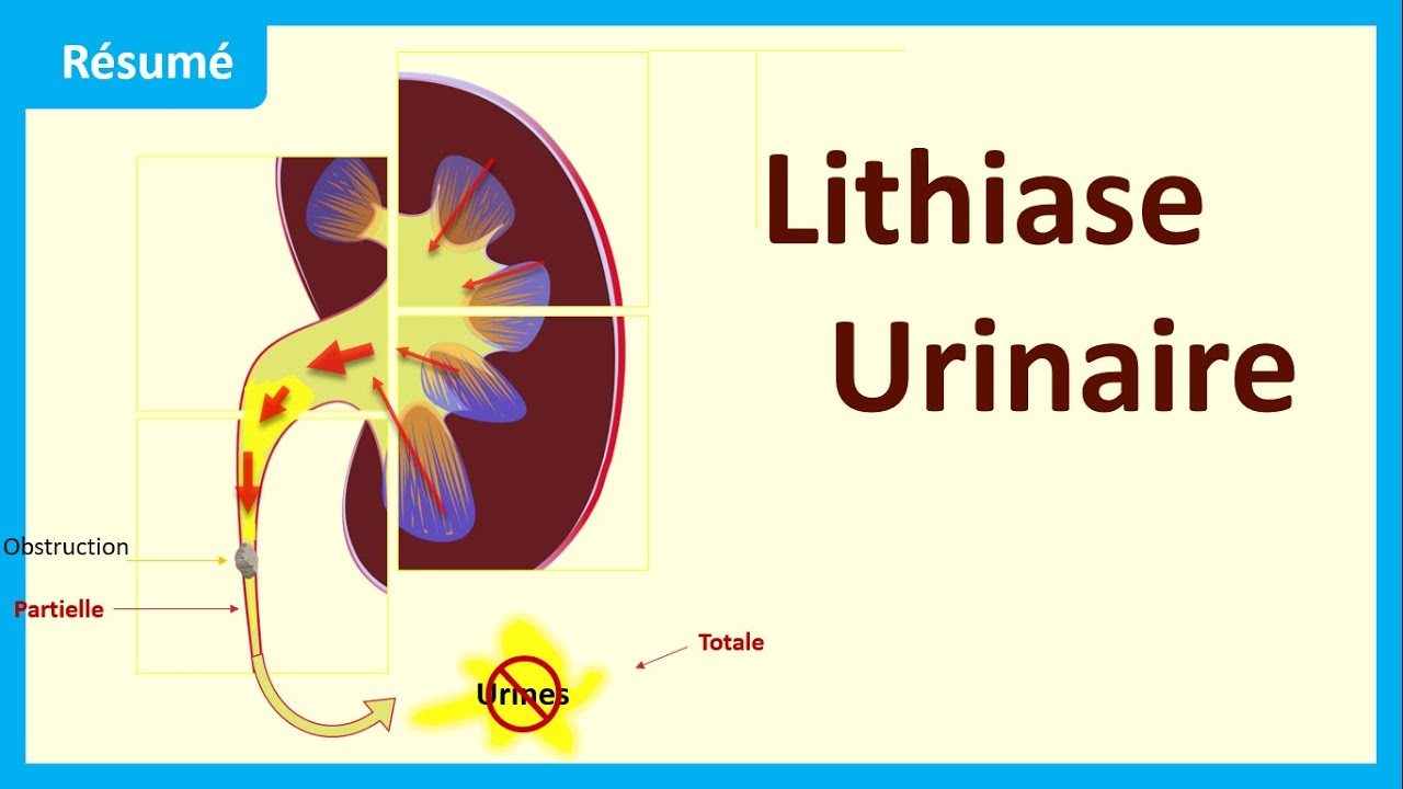 Lithiase urinaire 💧 : qu'est-ce que c'est ? 🧐 - Résumé - Uro ...