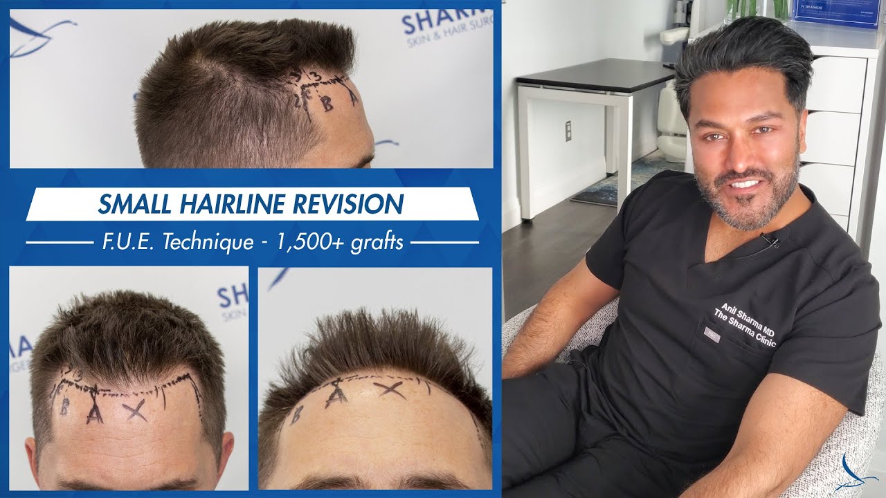 Small Hair Transplant - 1,500 grafts - YouTube