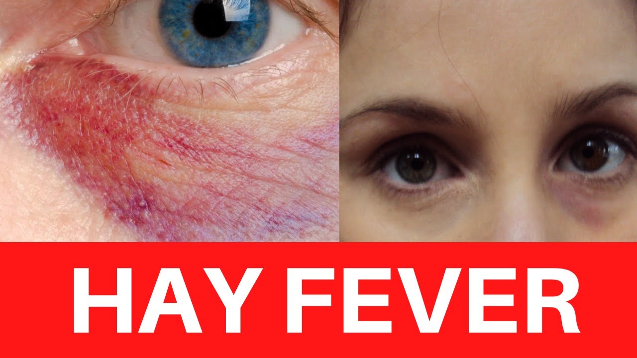 Hay Fever Symptoms, Causes, Treatment - YouTube