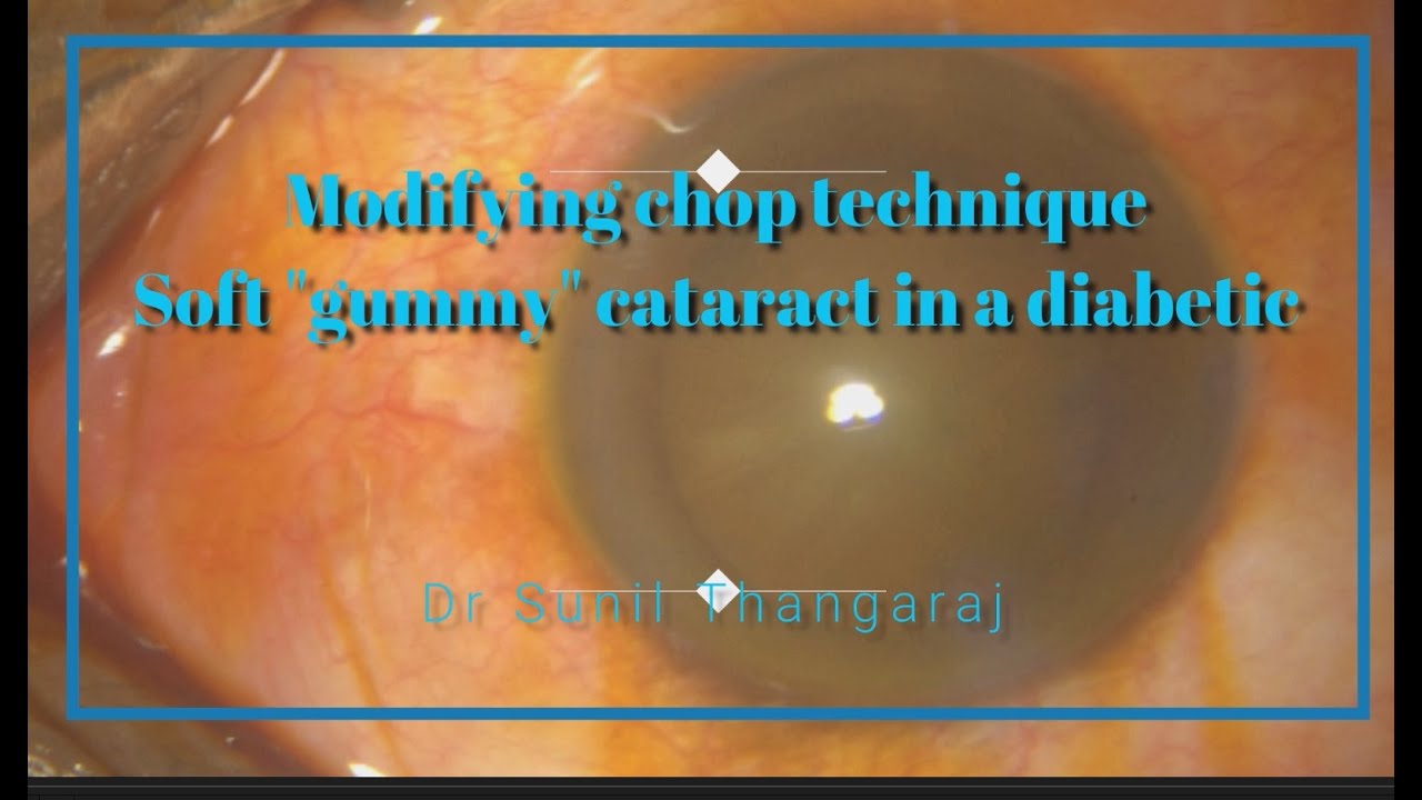 The diabetic soft gummy cataract - modifying the technique of ...