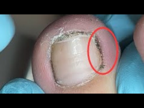 Best toenail dirt Cleaning - YouTube