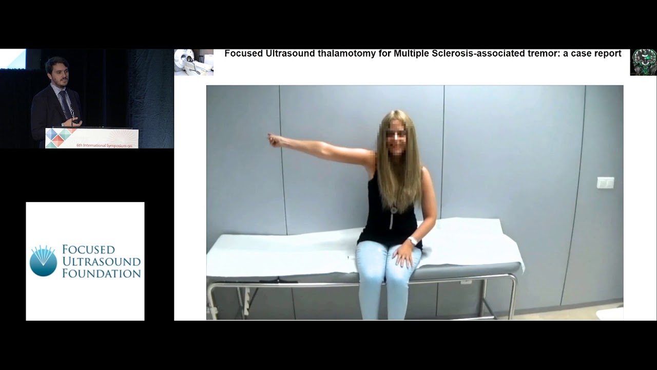 Jorge Manez Miro - FUS thalamotomy for multiple sclerosis-associated ...