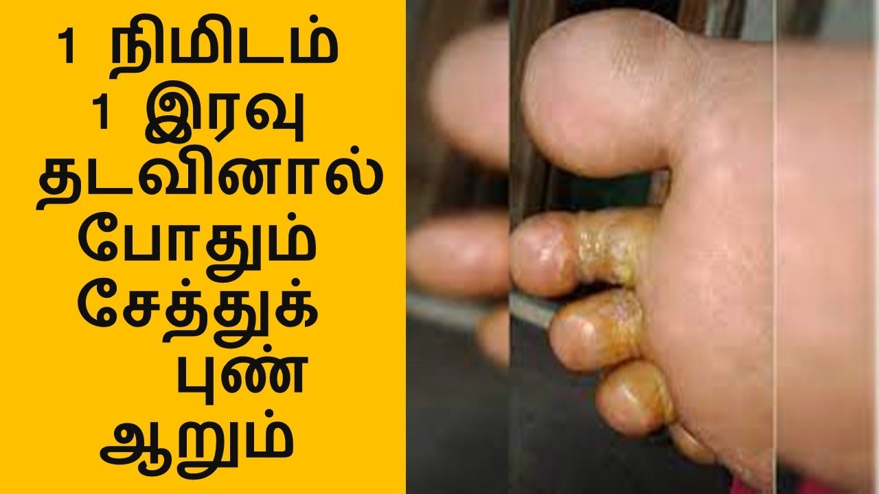 சேற்றுப்புண் குணமாக என்ன செய்ய வேண்டும்| setru pun marunthu|athlete’s ...