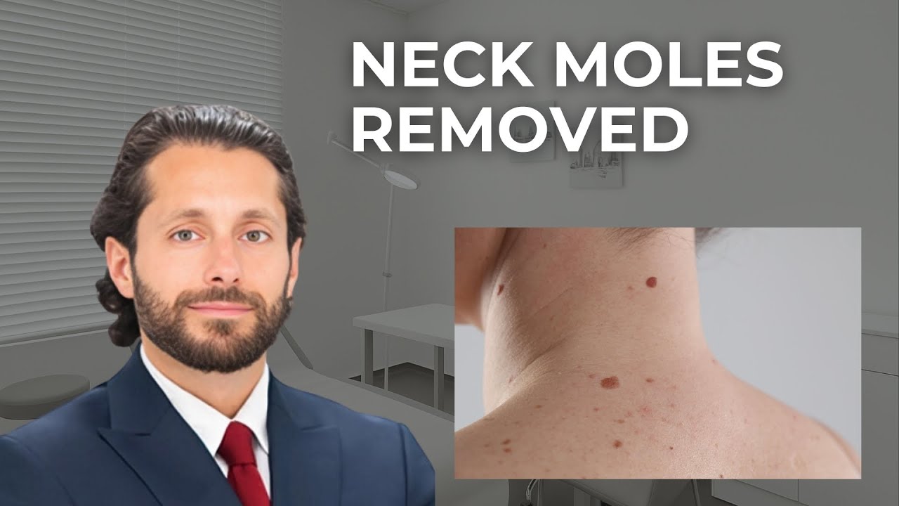 Multiple Neck Moles Removed | Real Procedure with Dr Parviz - YouTube