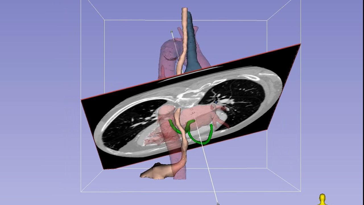 Mid-Esophageal 4-Chamber Imaging Plane in TEE - Standard View - YouTube