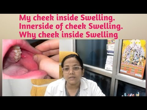 My cheek inside Swelling.Innerside of cheek Swelling,Why cheek inside ...