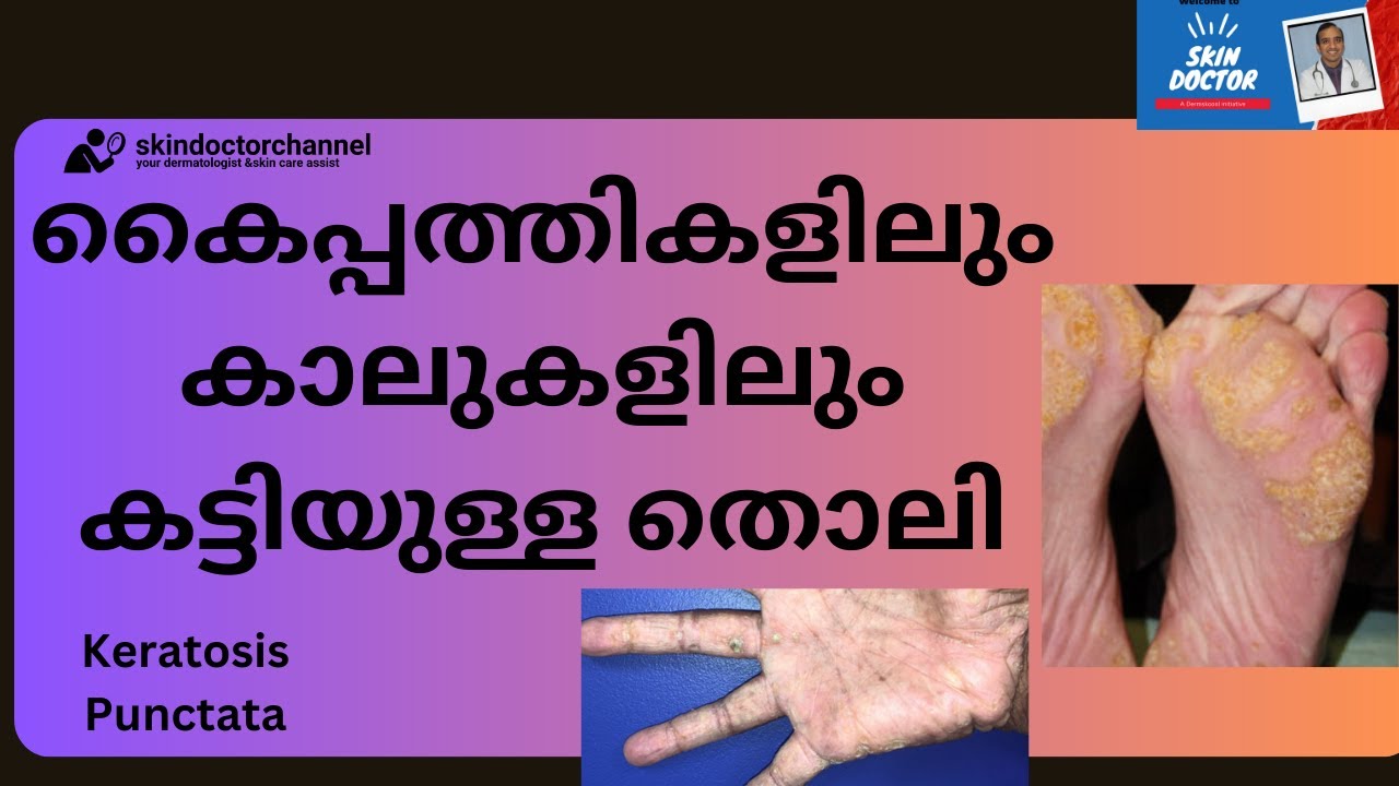 thick skin on hands / feet malayalam,കൈപ്പത്തികളിലും കാലുകളിലും ...